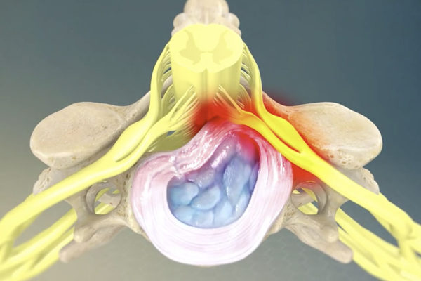 Spondylotic Myelopathy - Carl Spivak, MD - Executive Spine Surgery