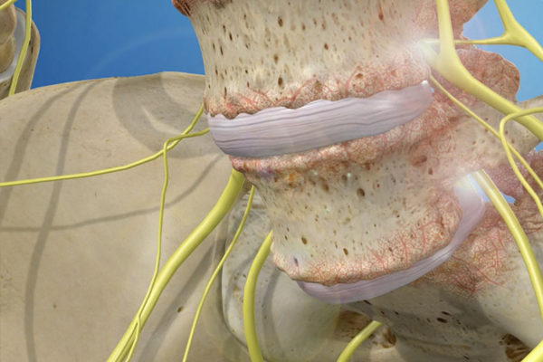 Spondylolithesis / Slipped Disc - Carl Spivak, MD - Executive Spine Surgery