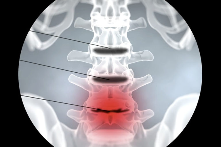 Discography - Carl Spivak, MD - Executive Spine Surgery