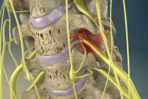 Posterior Cervical Fusion - Carl Spivak, MD - Executive Spine Surgery